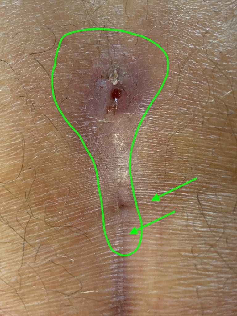 > 80 klinische Bilder vor und nach OP | Pilonidal Sinus Zentrum