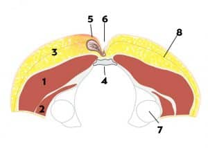Karydakis Operation Operationstechnik | Pilonidal Sinus Zentrum