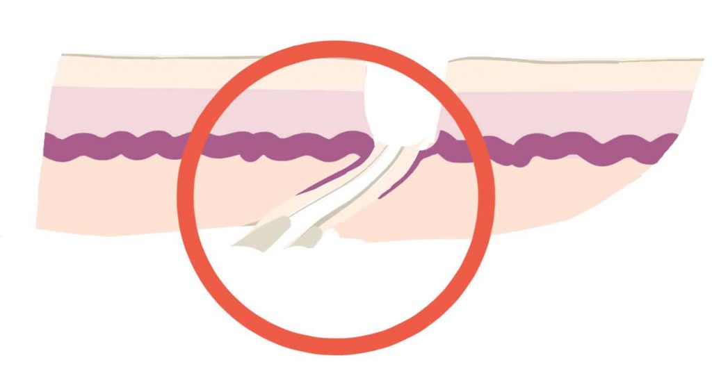 Pit Picking Operationstechnik | Pilonidal Sinus Zentrum München