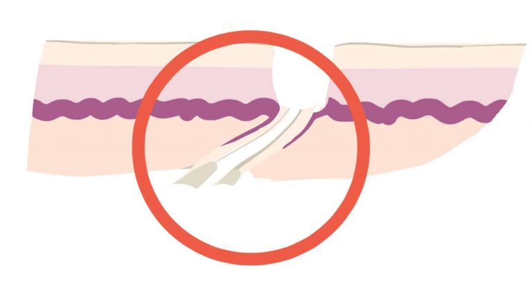 Pit Picking Operationstechnik | Pilonidal Sinus Zentrum München